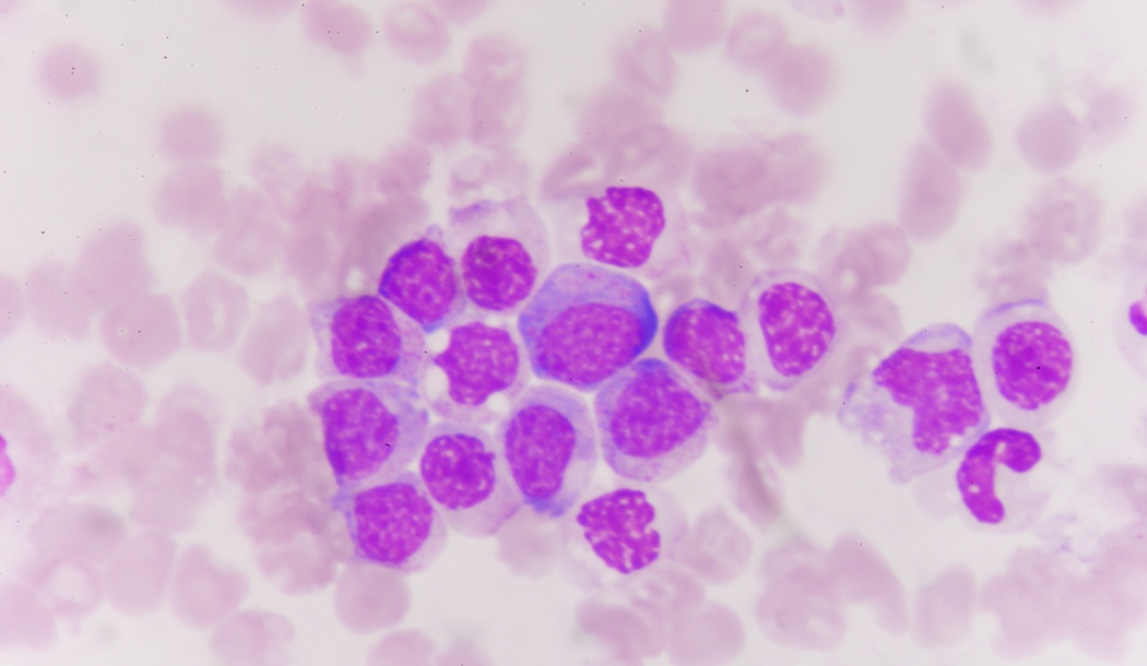 Cancer Defeated | When Cancer Is A Microbial Infection…